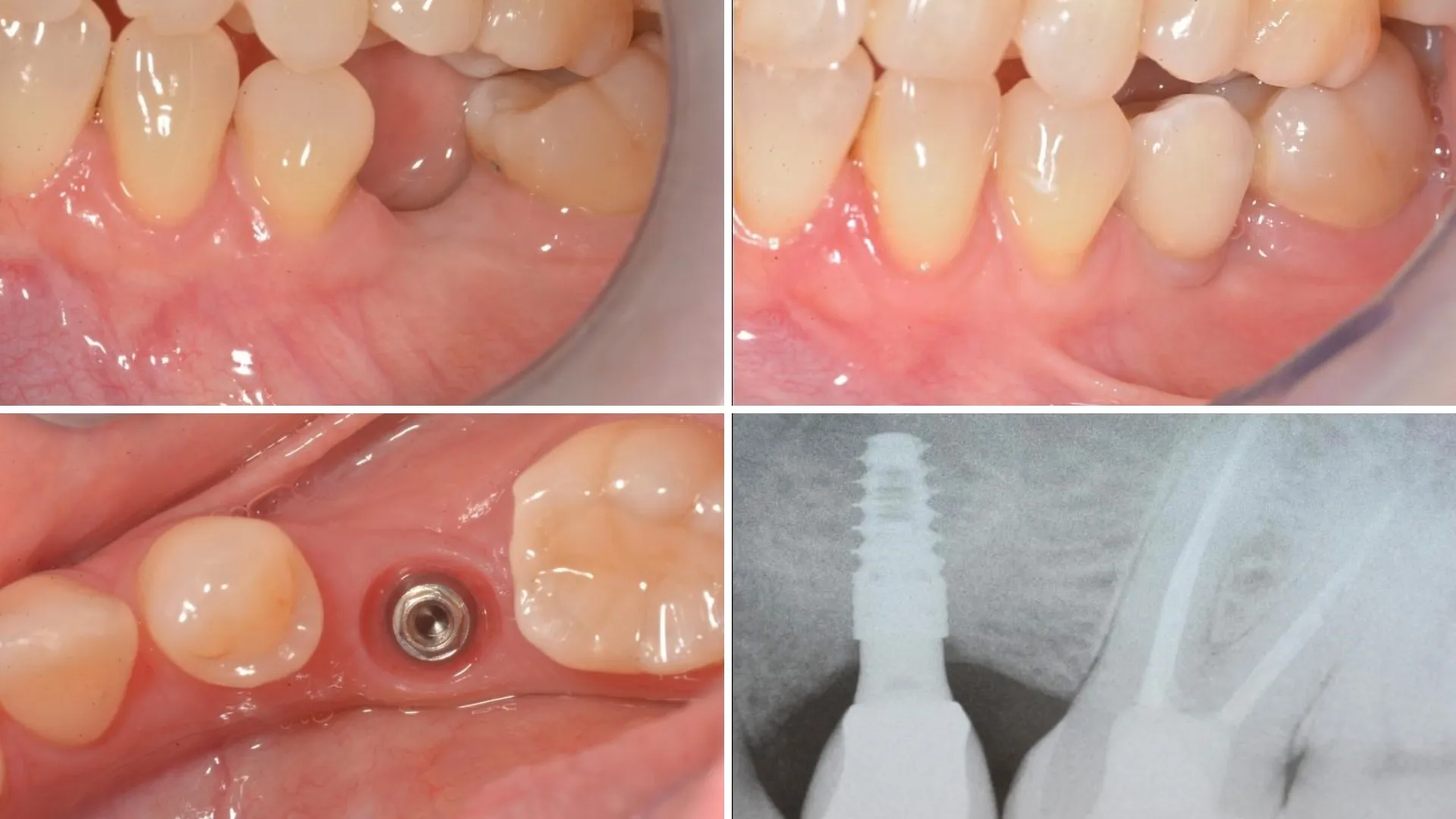Impact Compressive Sharp Tip Dental Implant 4.20 mm