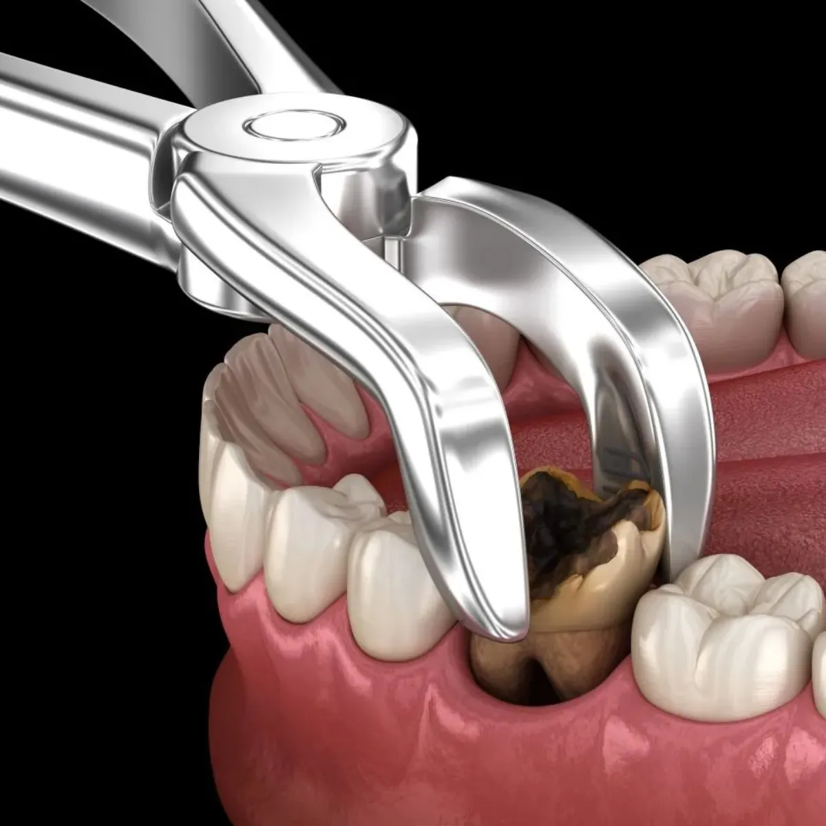 Medesy Lower Molar Extraction Forceps Online at Best Price | Dentalkart.com