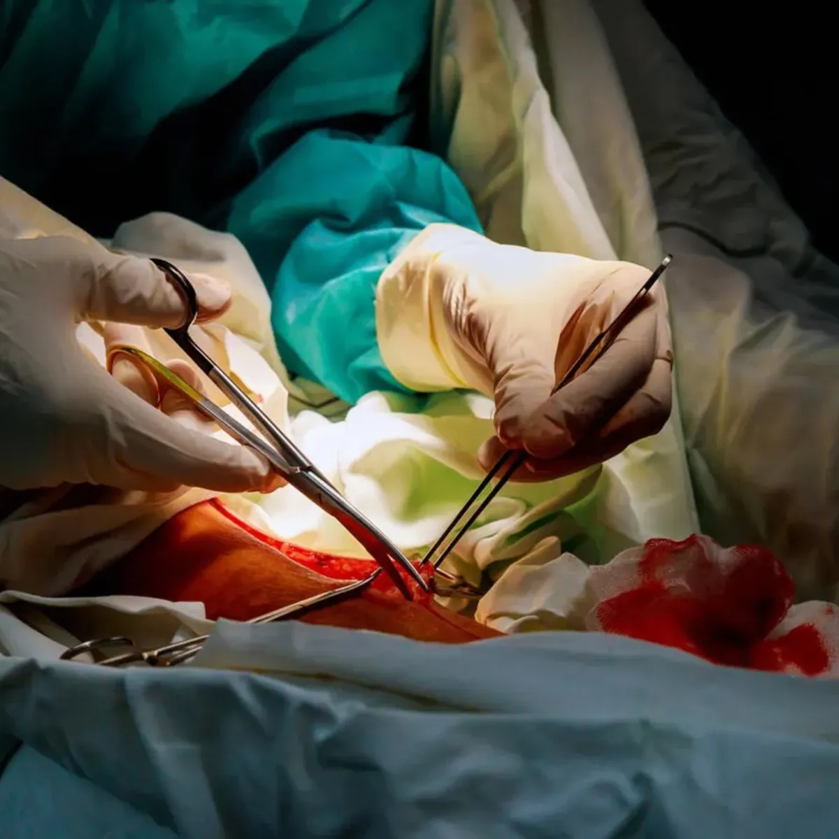 Buy Medesy Saw Edge Surgical Scissors - Angular 160mm (3503) Online at Best Price | Dentalkart.com