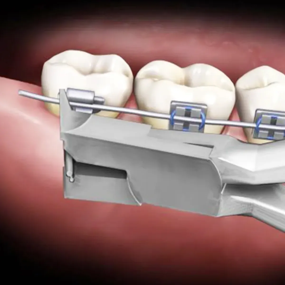 GDC Orthodontics Cutter Tc Distal End Cutter Short Handle