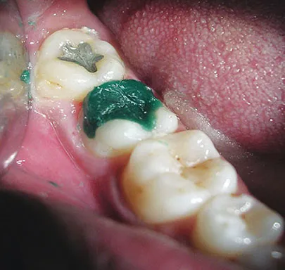 Buy Maarc Pattern Wax Online at Best Price | Dentalkart.com