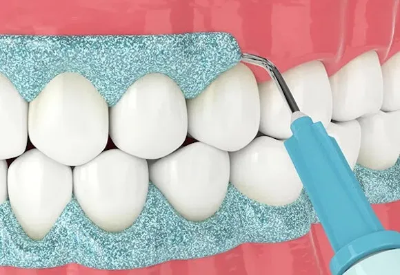 Buy Maarc Blitz White Bleaching Kit Online at Best Prices | Dentalkart