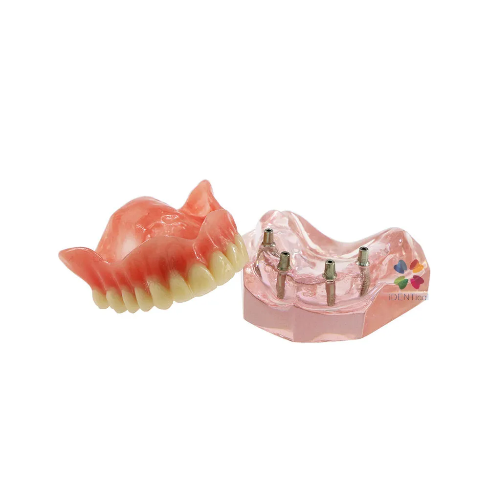 Buy iDENTical Overdenture Maxilla Model M6001:with Edentulous Solutions ...