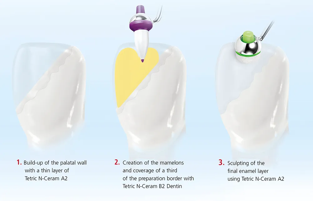 Buy Ivoclar Tetric N Ceram Composite Kit & Refills at best price on ...