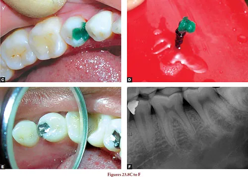 Buy Maarc Pattern Wax Online at Best Price | Dentalkart.com