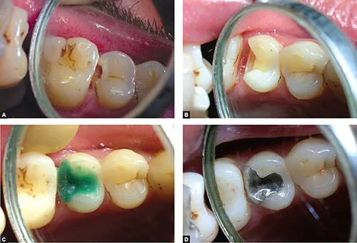 Maarc Pattern Wax Online at Best Price | Dentalkart.com