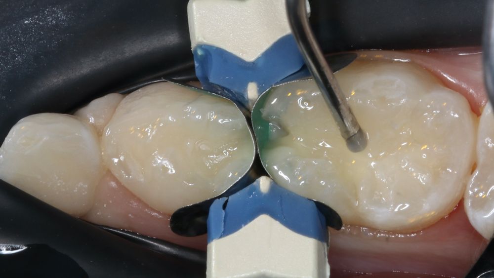 SafeEndo ReCreate LC Flow | Dentalkart
