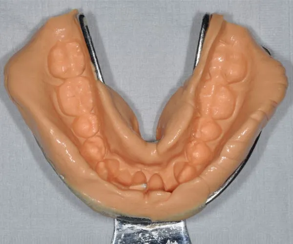 Waldent Rim-Lock Impression Trays | Dentalkart