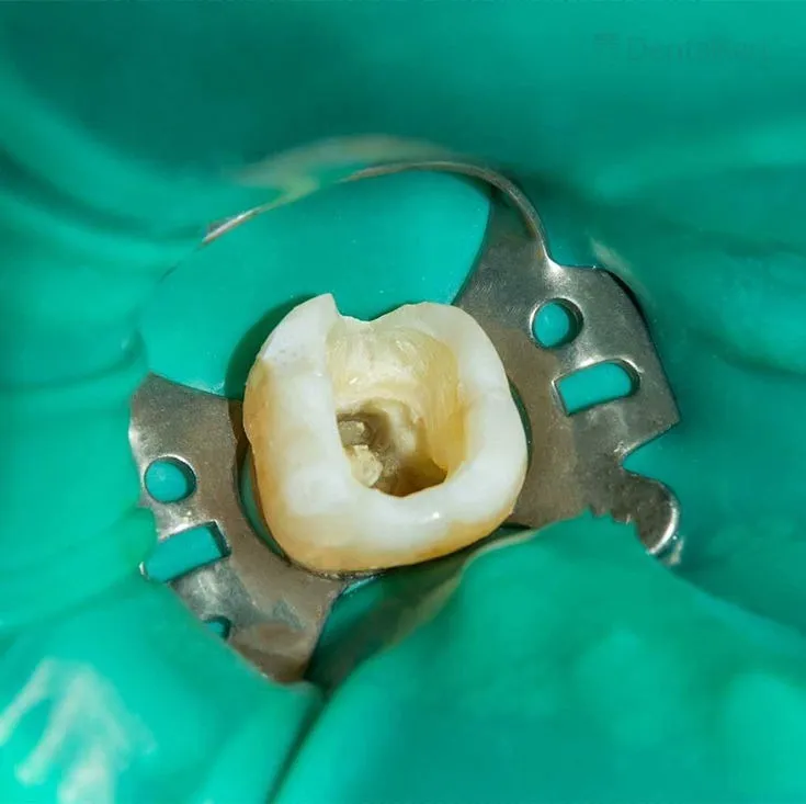 Coltene Brinker Tissue Retractors Universal Clamp Set