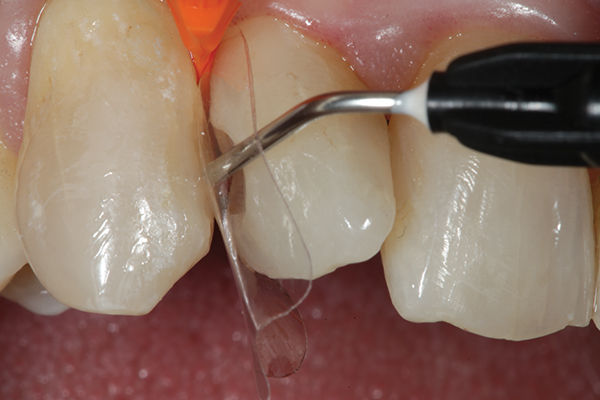 SafeEndo ReCreate LC Flow | Dentalkart