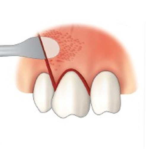 Waldent Molt No.9 Periosteal Elevator - Ergonomic, Lightweight, Rust ...