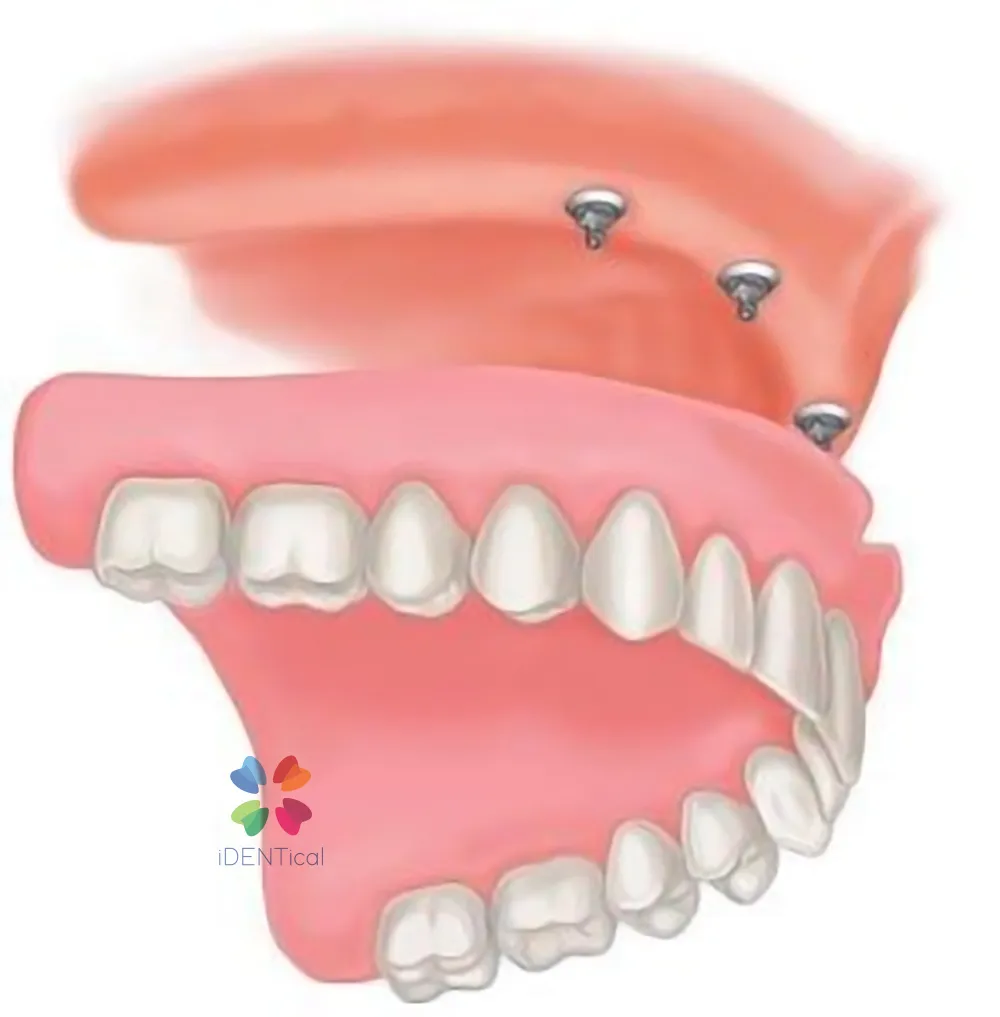 Buy iDENTical Overdenture Maxilla Model M6001:with Edentulous Solutions ...