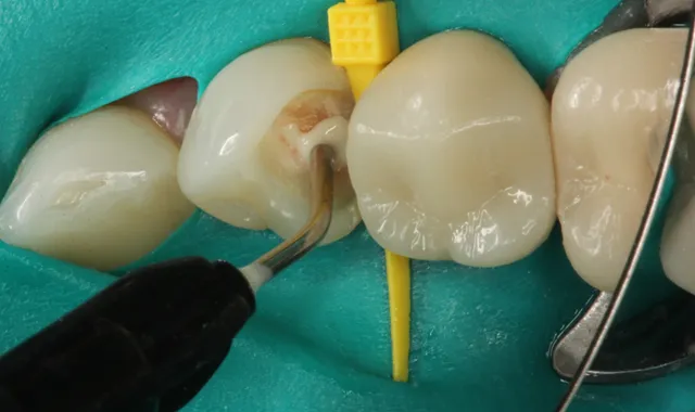 Buy Apacal Art by Prevest Direct- Dental Pulp Capping & Protection