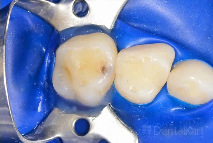 Buy Waldent Rubber Dam Clamps Pedo (Set of 20) - Precision Pediatric ...