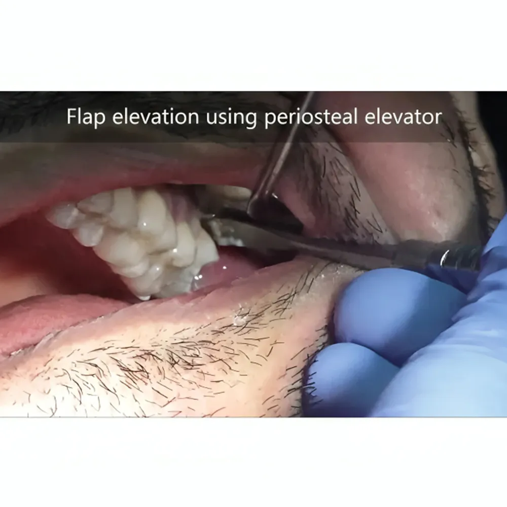 Buy Oracraft Periosteal Elevators | Best Quality Dental Periosteal ...