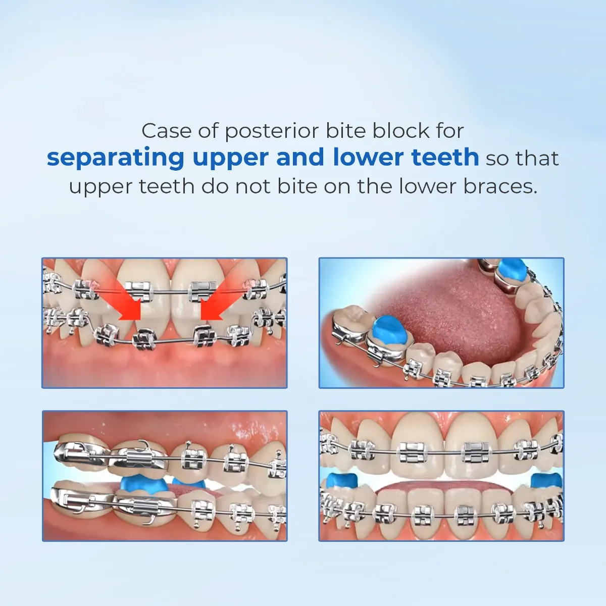 Waldent Blue Bite-Block | Dentalkart