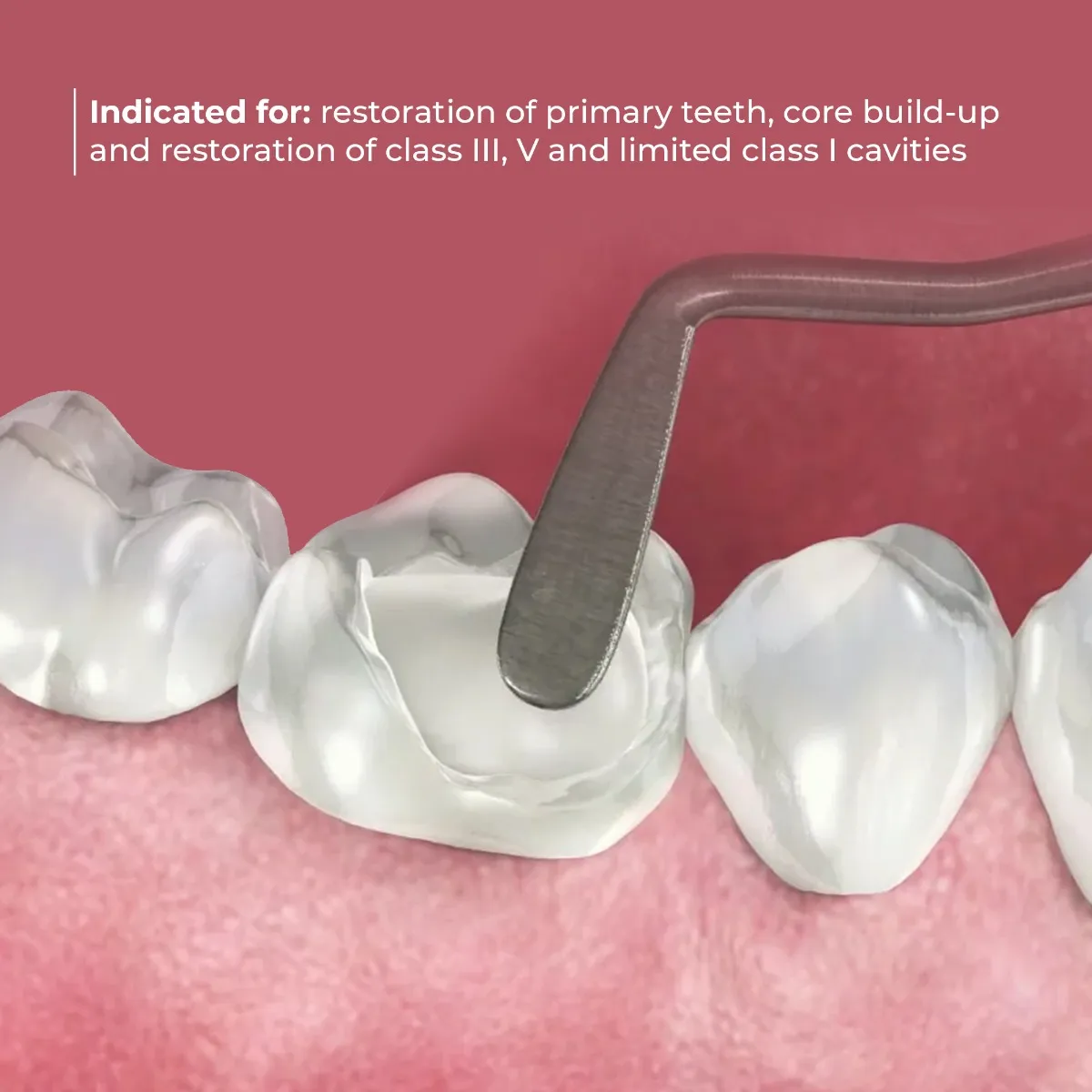 DentGist Bio Glass Gold Restorative GIC (Big Pack) | Dentalkart