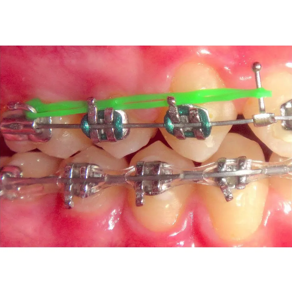 Buy Ortho Direct Crimpable Ball Hooks Online - Best Dental Ball Hooks ...