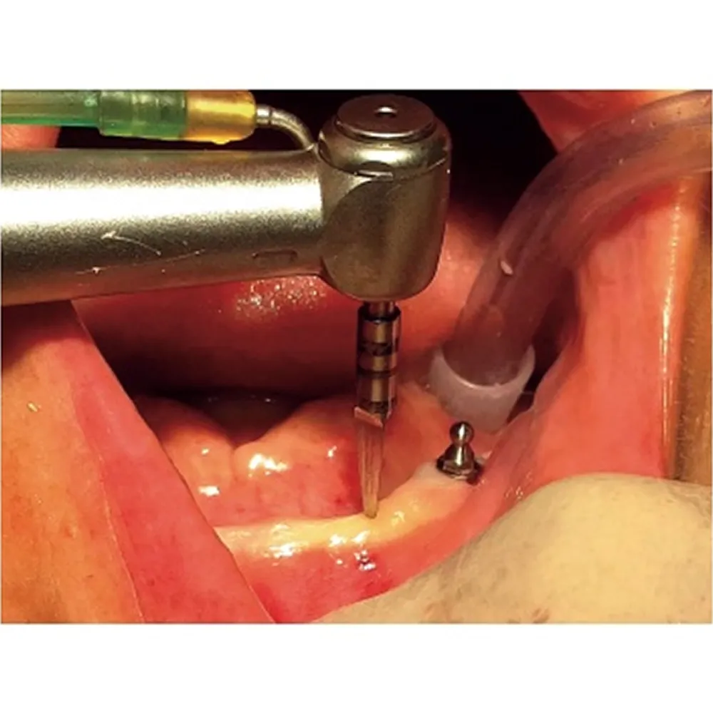 Julldent Basal Drill Kit and Refills