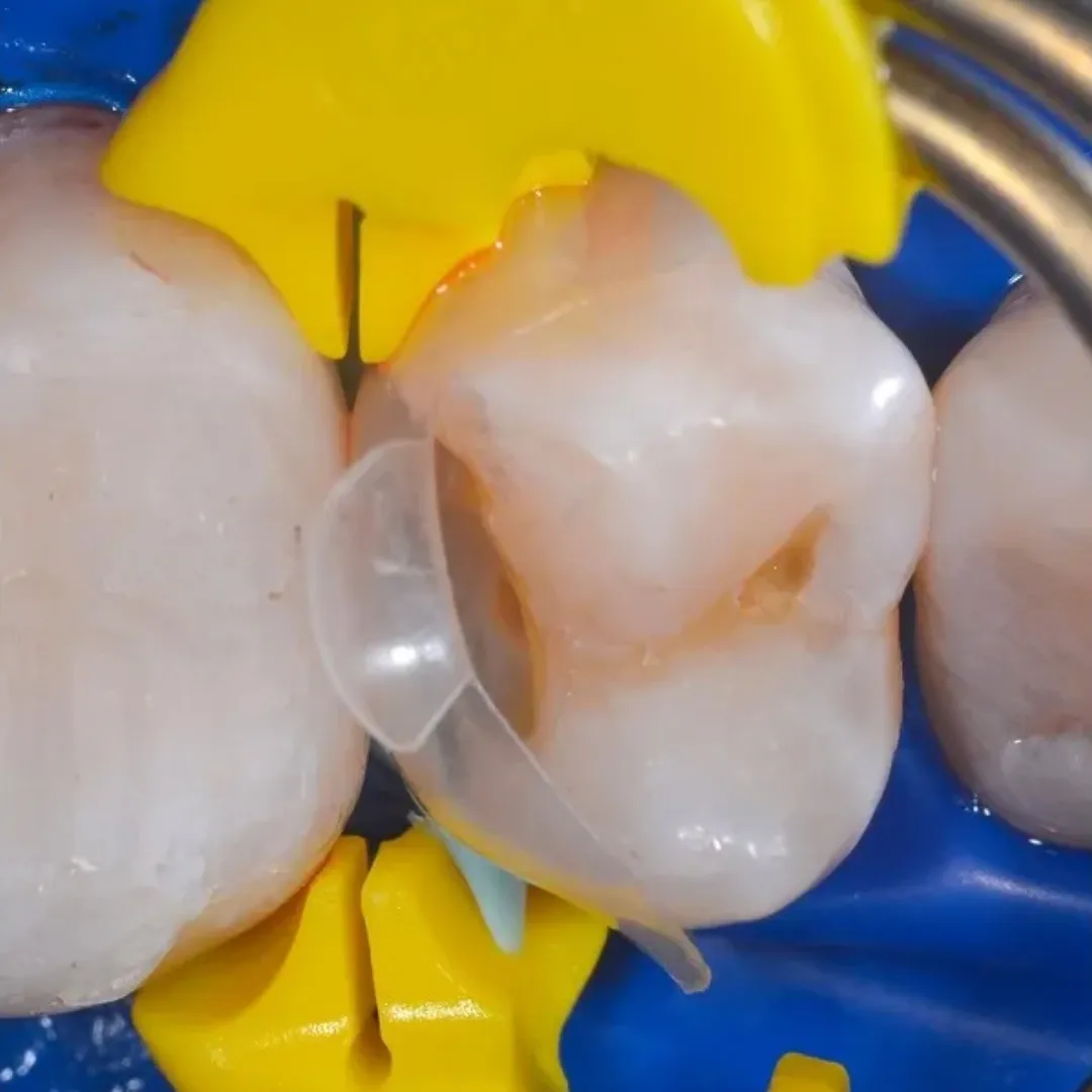 Bioclear Biofit HD Posterior Matrix System Refill Packs