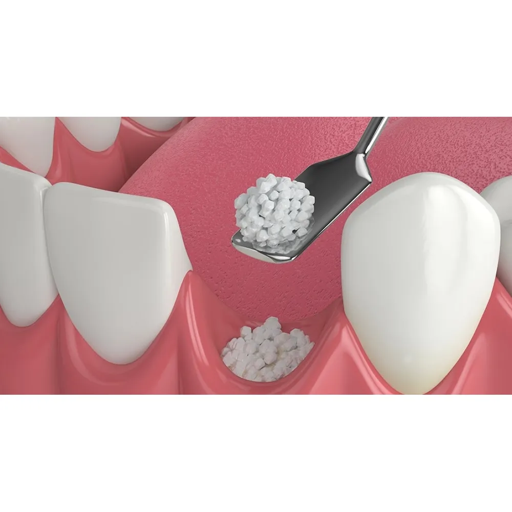 Buy GDC Bone Grafting Instruments Online | Dental Bone Grafting Tools ...