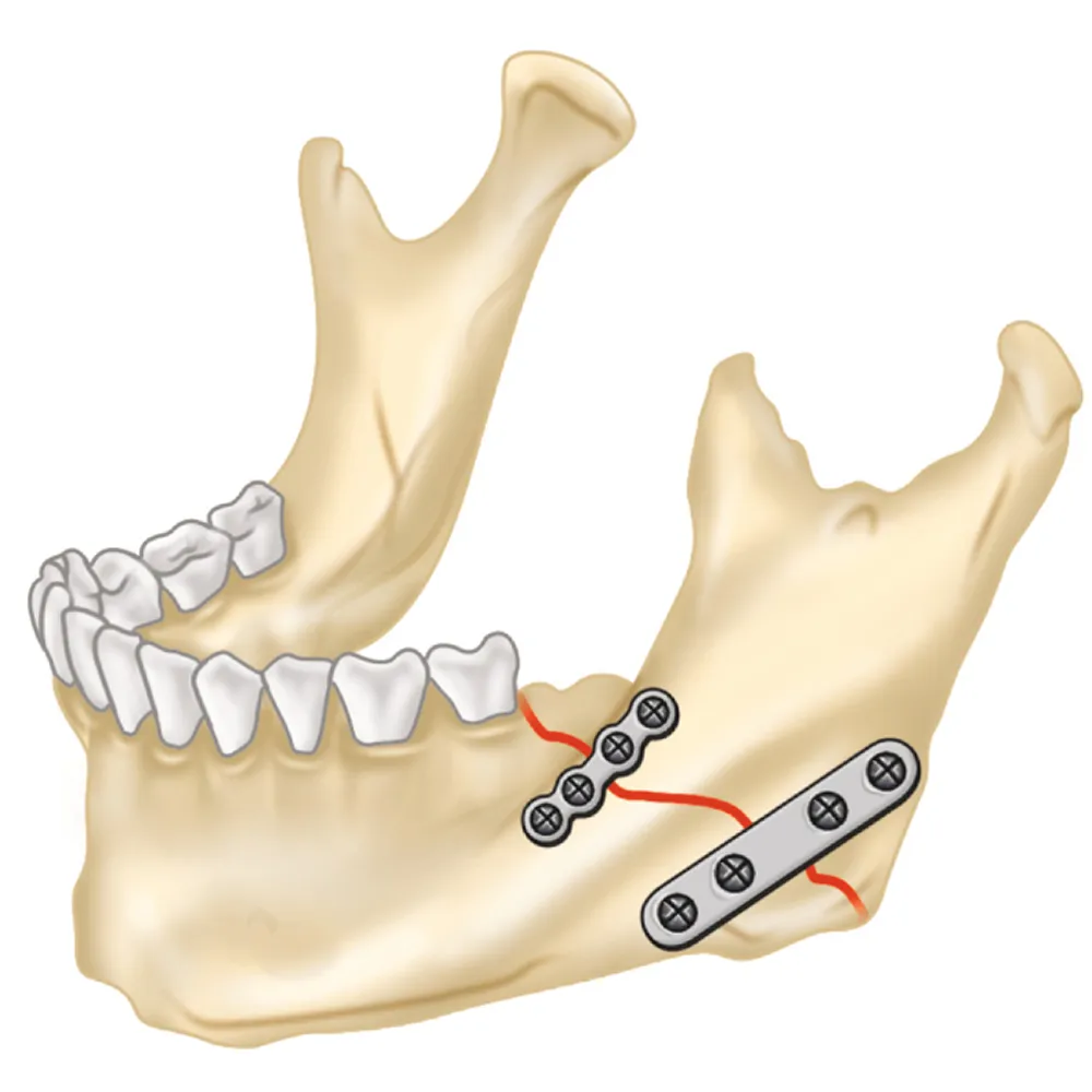 SK Surgicals SS Mini Bone Plates Continuous - 1.5mm