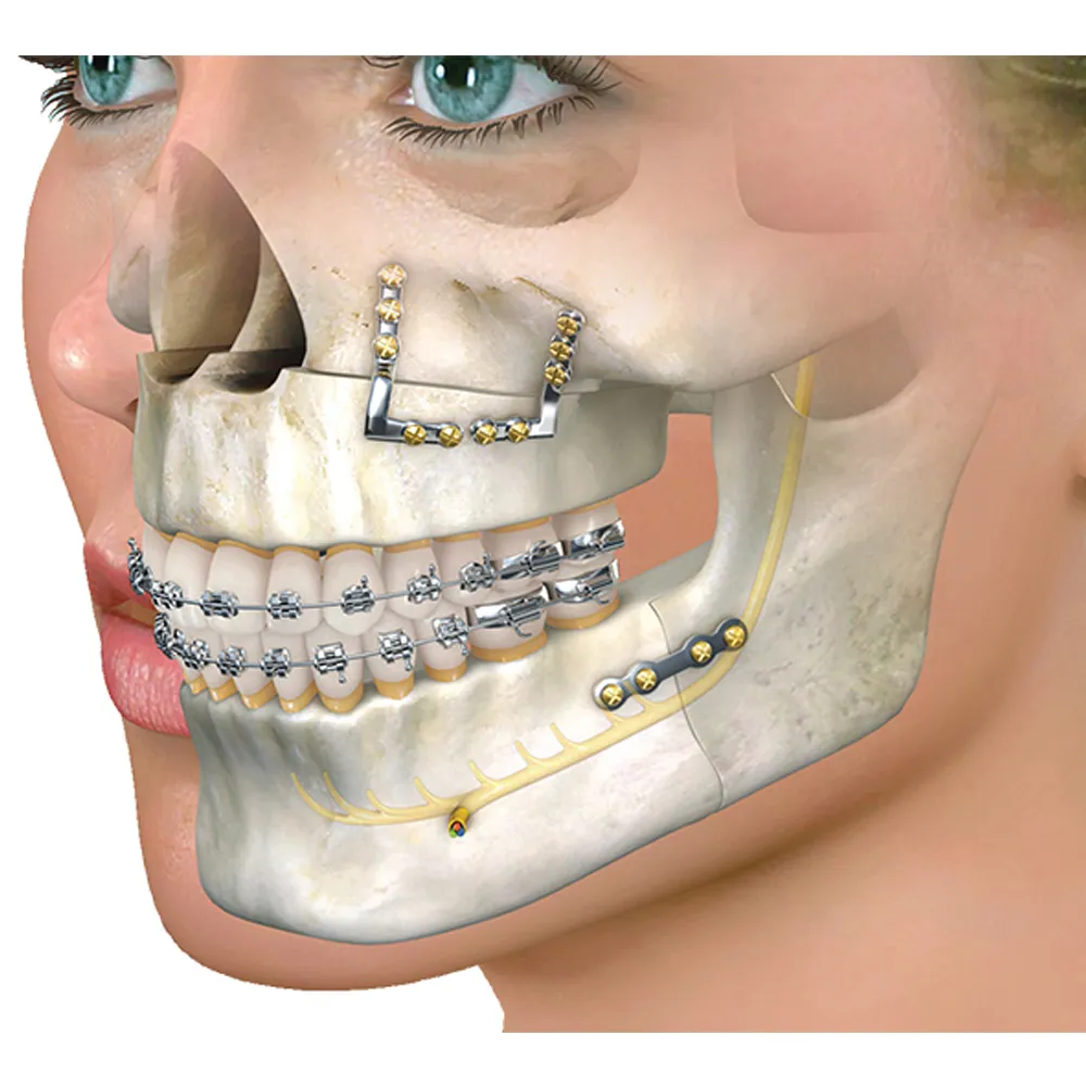 SK Surgicals SS Mini Bone Plates L Shape 90° With Gap - 1.5mm