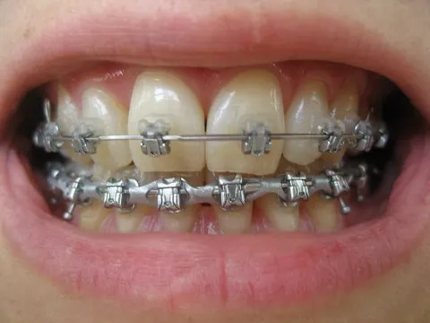 U Orthodontics E-Chain Continuous Long Grey
