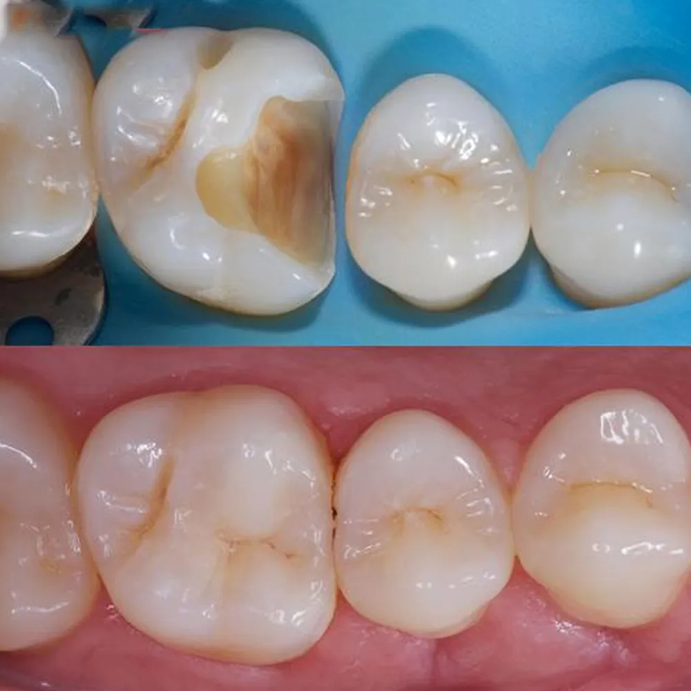 Prime Dental Restorite Bulk Fill (Packable)