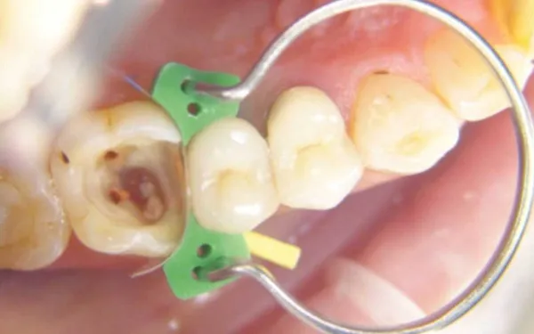 Shop Russia Tor Vm Sectional Contoured Matrices Kits - Best Sectional ...