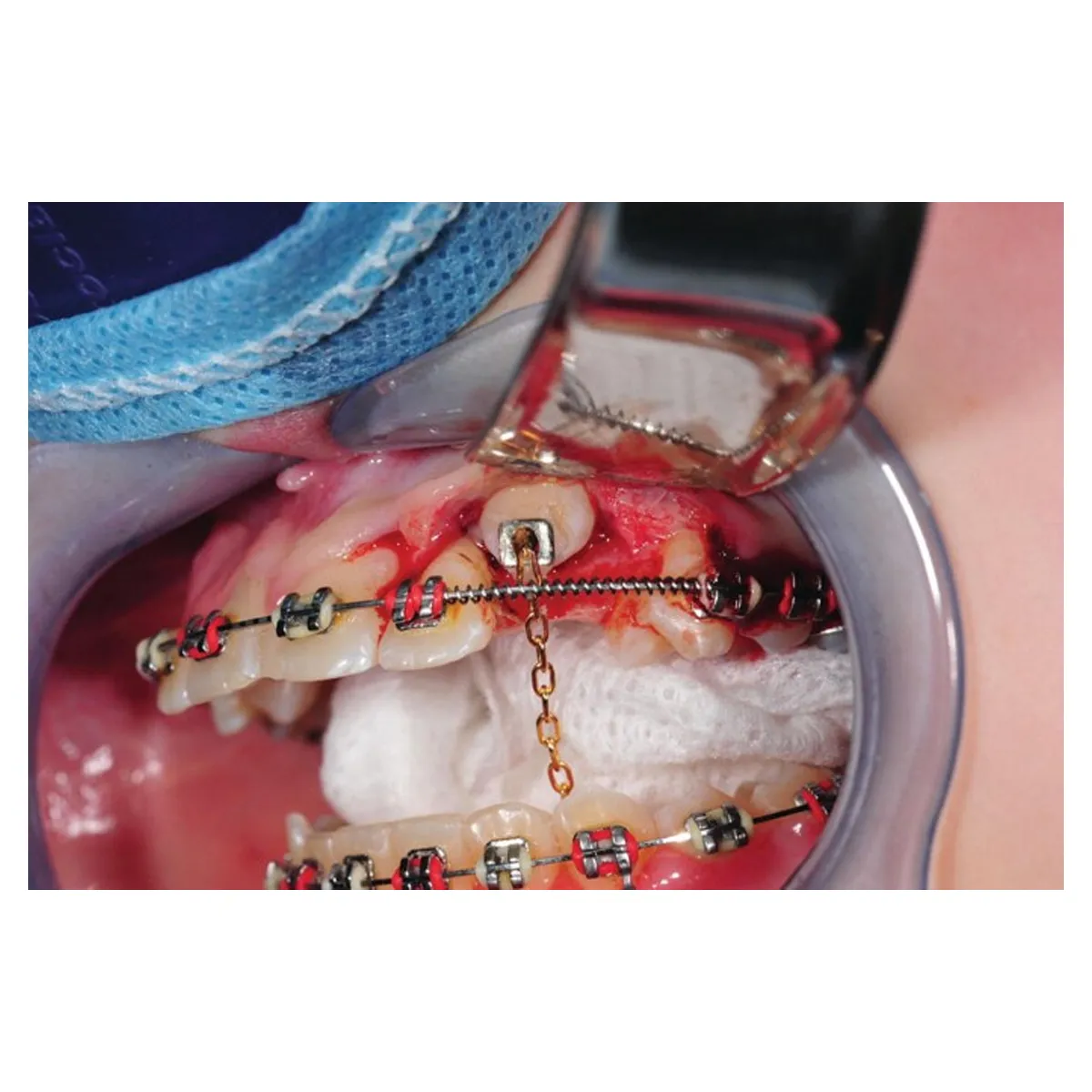 JJ Ortho Button And Chain Eruption Appliance (60.01.69E)