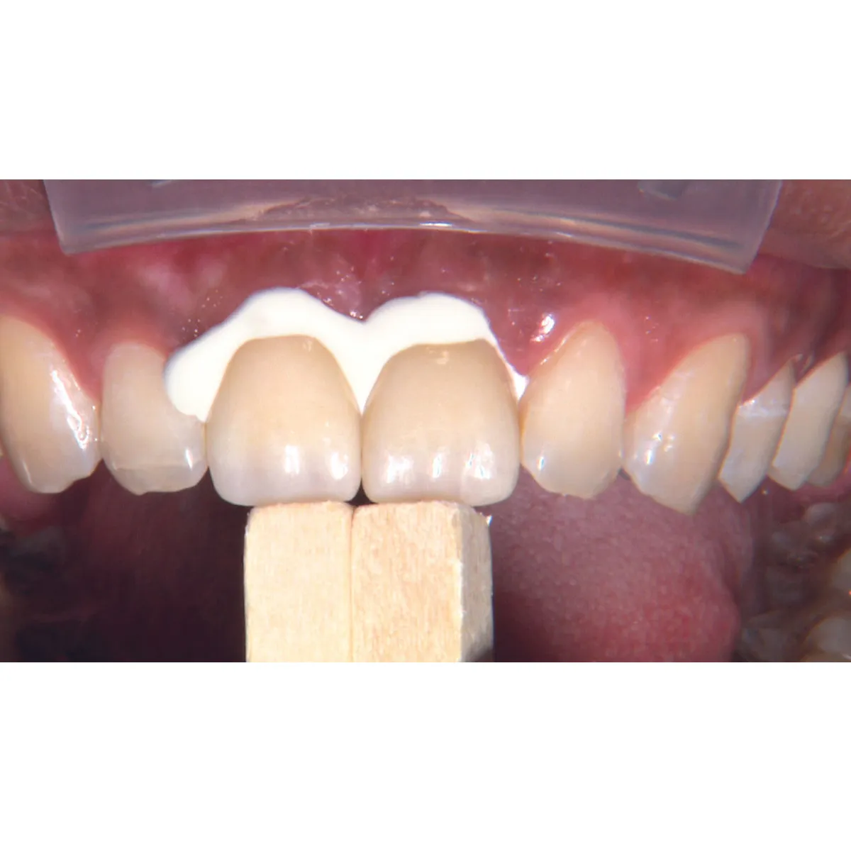 Kids-e-Crown Zirconia Upper Central Incisor Refills