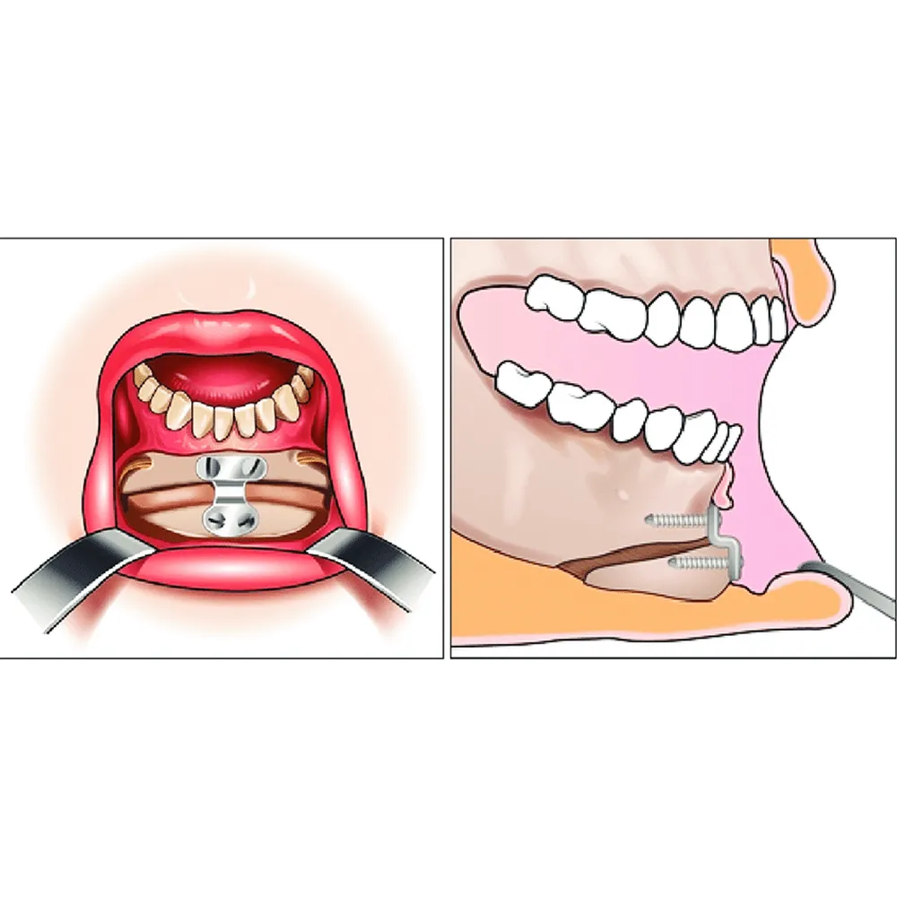 SK Surgicals Titanium Mini Chin Plates 2mm