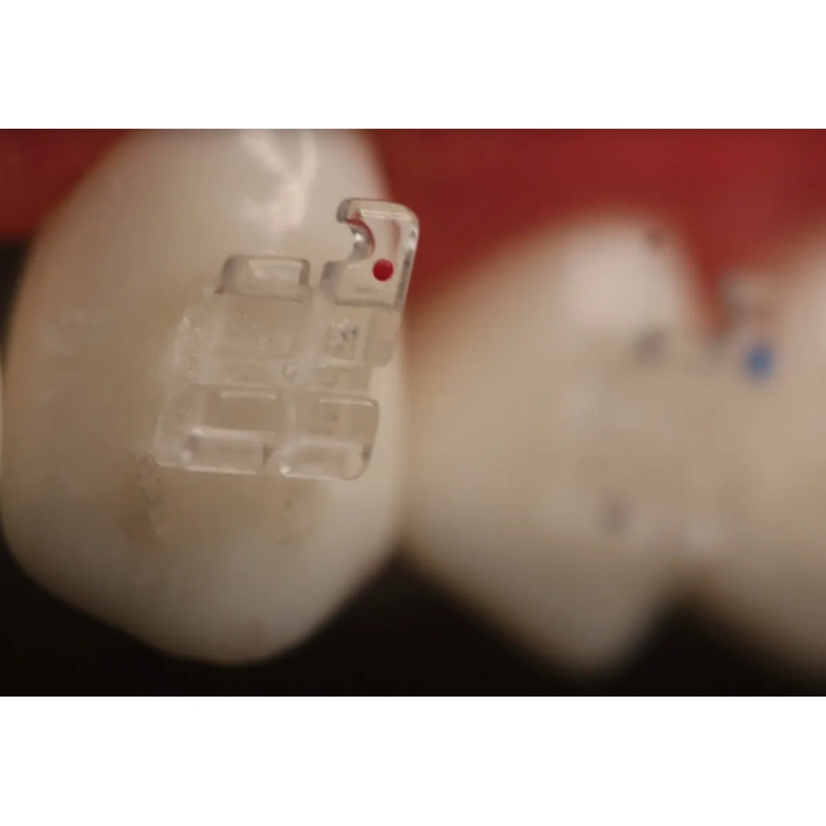 Buy Koden Clear HD MBT Bracket Kits Online | High-Quality Clear ...