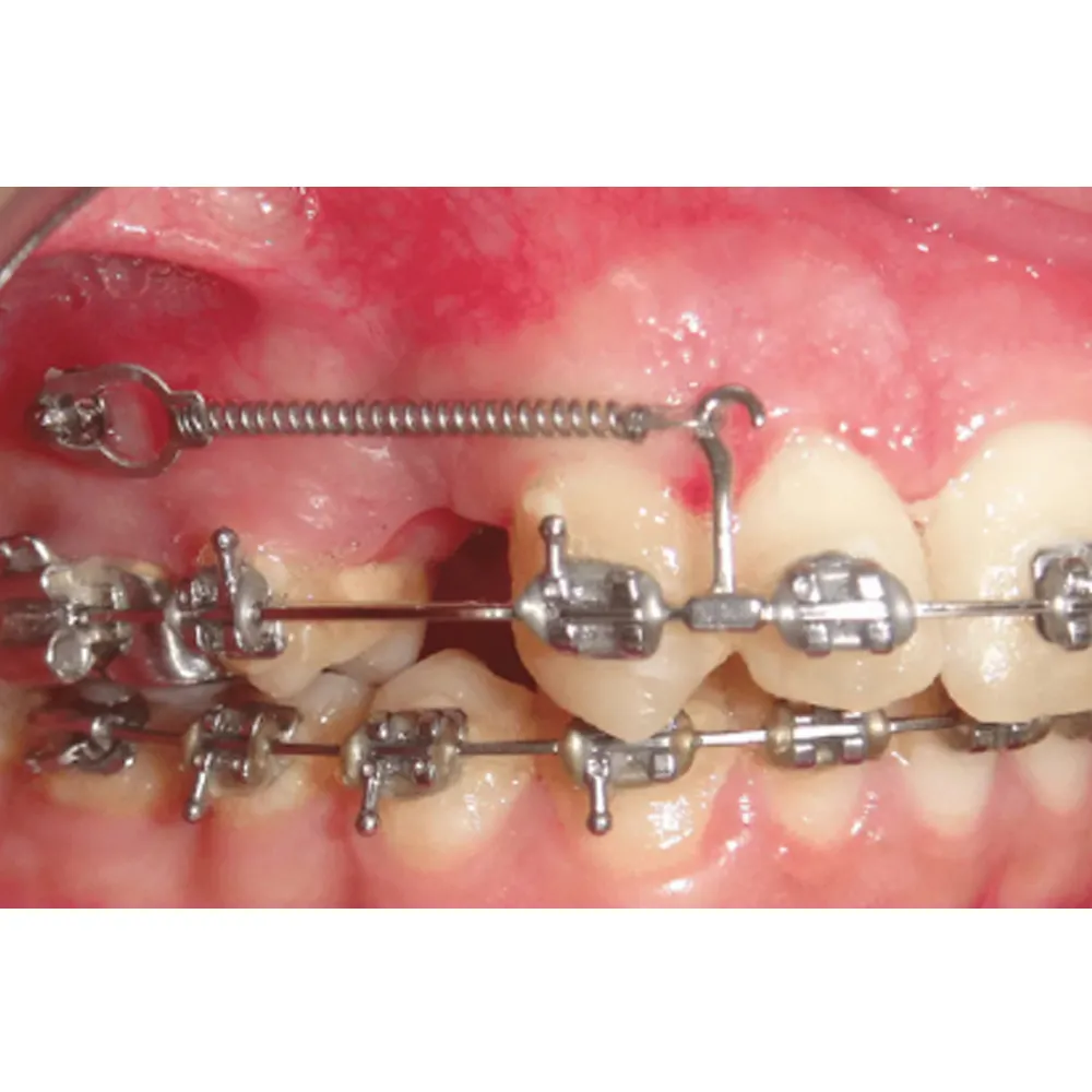 Koden NiTi Closed Coil Spring (Pack of 10)