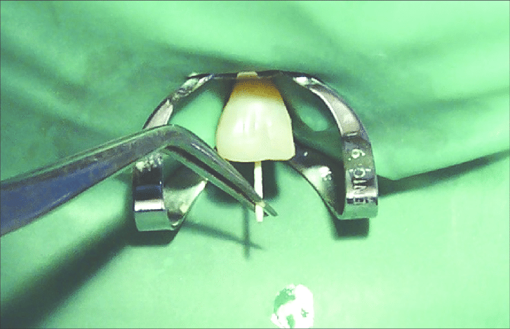 Buy DiaDent Millimeter Marked Paper Points - 2% for Precise Root Canal ...