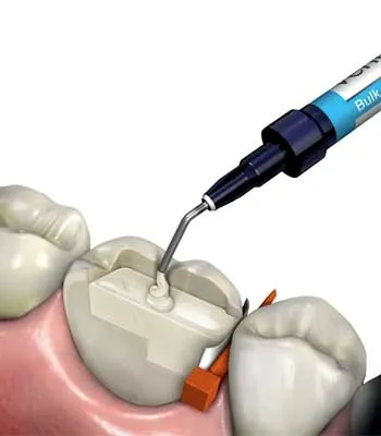 Ivoclar Te-Econom Flow Composite | Dentalkart