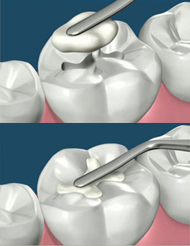 Shop Dentsply Spectrum Composite Kit: Best Dental Composite Materials ...