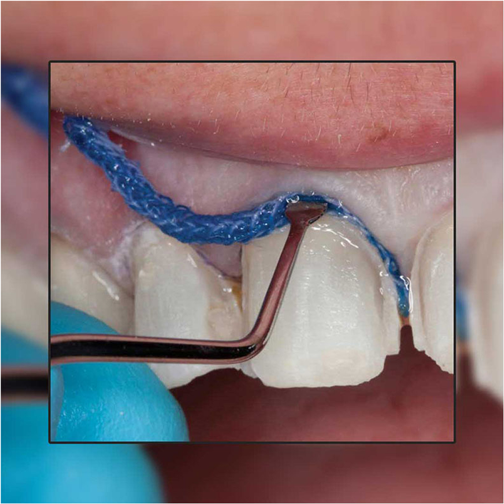 GDC Gingival Cord Packer - Serrated #4 (Hollow Ring Handle)