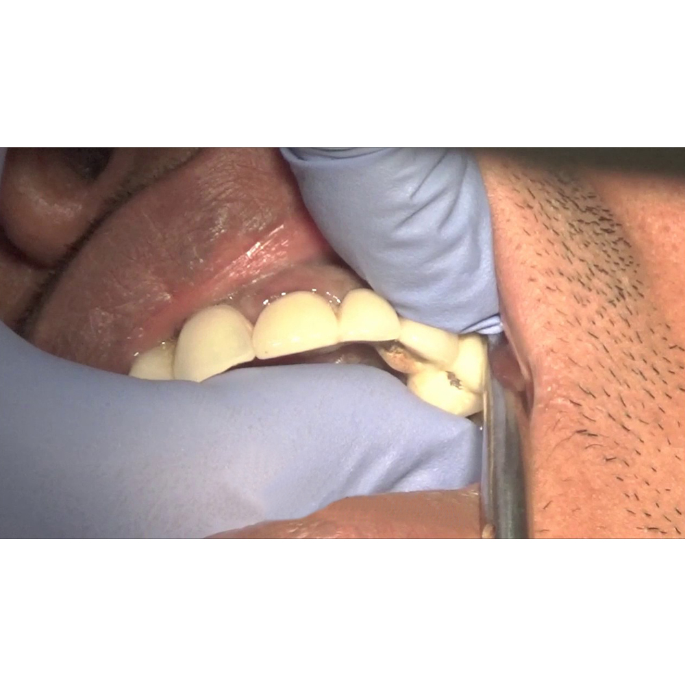 GDC Automatic # Premium Crown Remover (Crp) Buy GDC Automatic # Premium ...