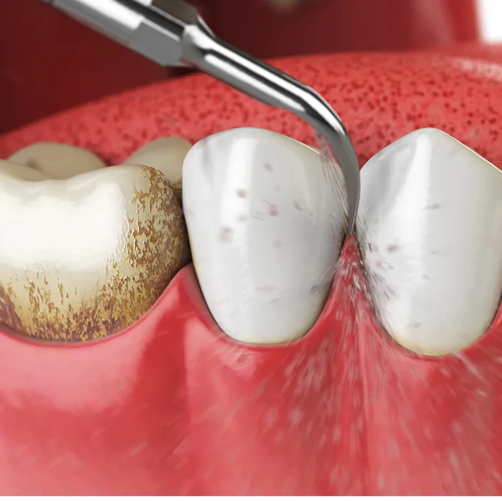 Woodpecker Endodontic Scaler Tips for DTE & Satelec Scalers