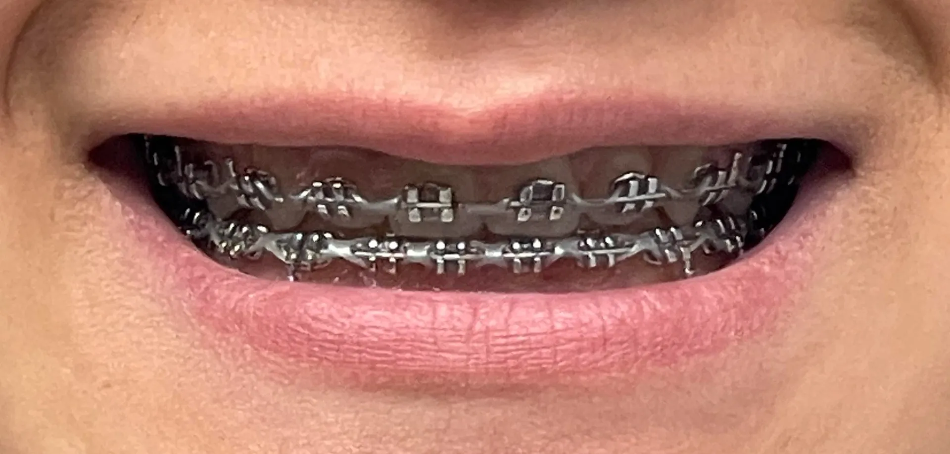 U Ortho E-Chain (15 ft) - Short Grey Online at Best Price | Dentalkart.com