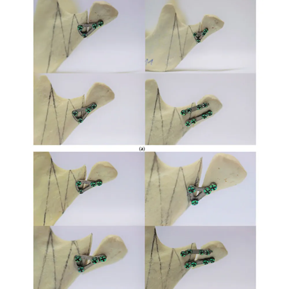 SK Surgicals Titanium Mini Bone Delta Plates - 2mm (300.501T)