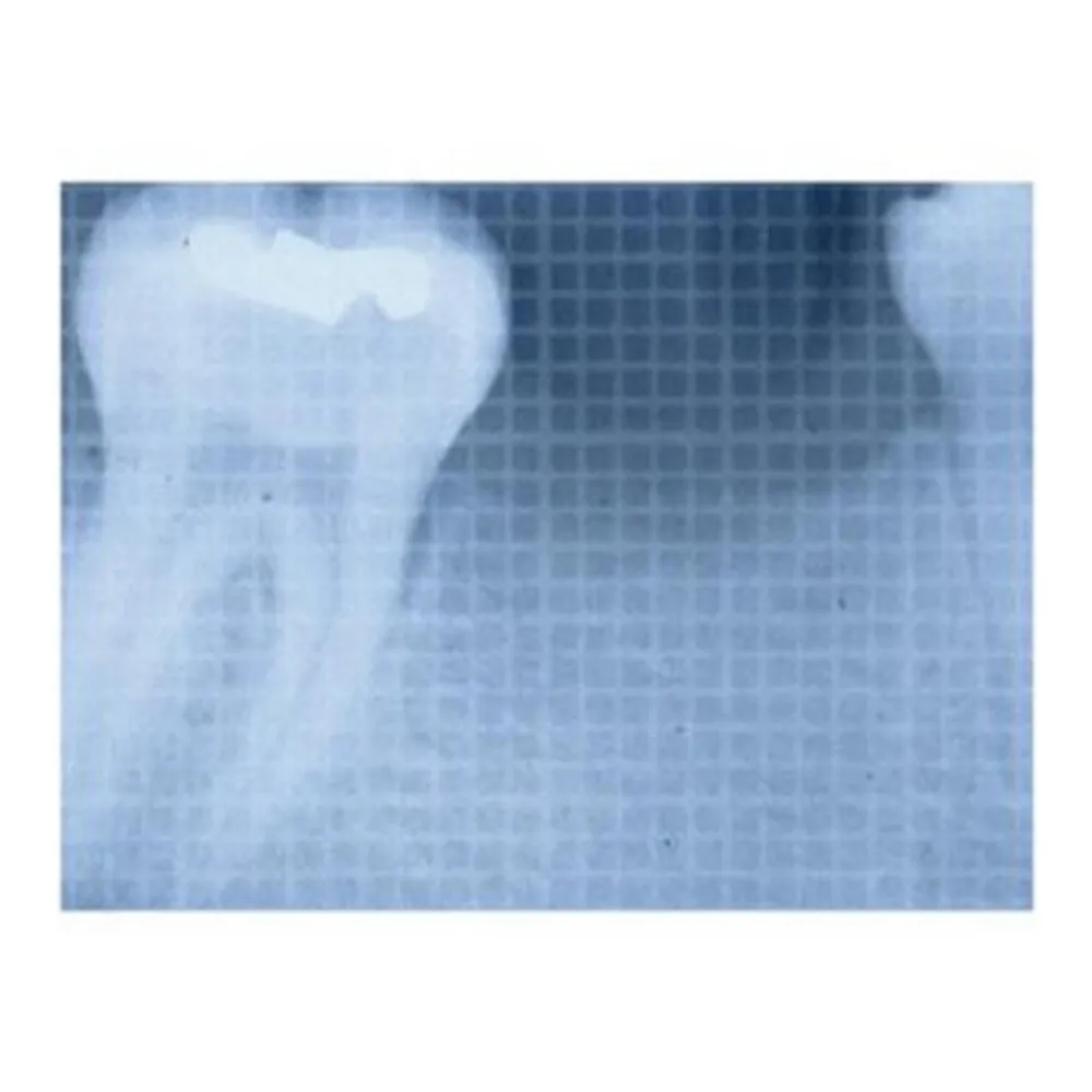 Dental IOPA X-Ray Grid