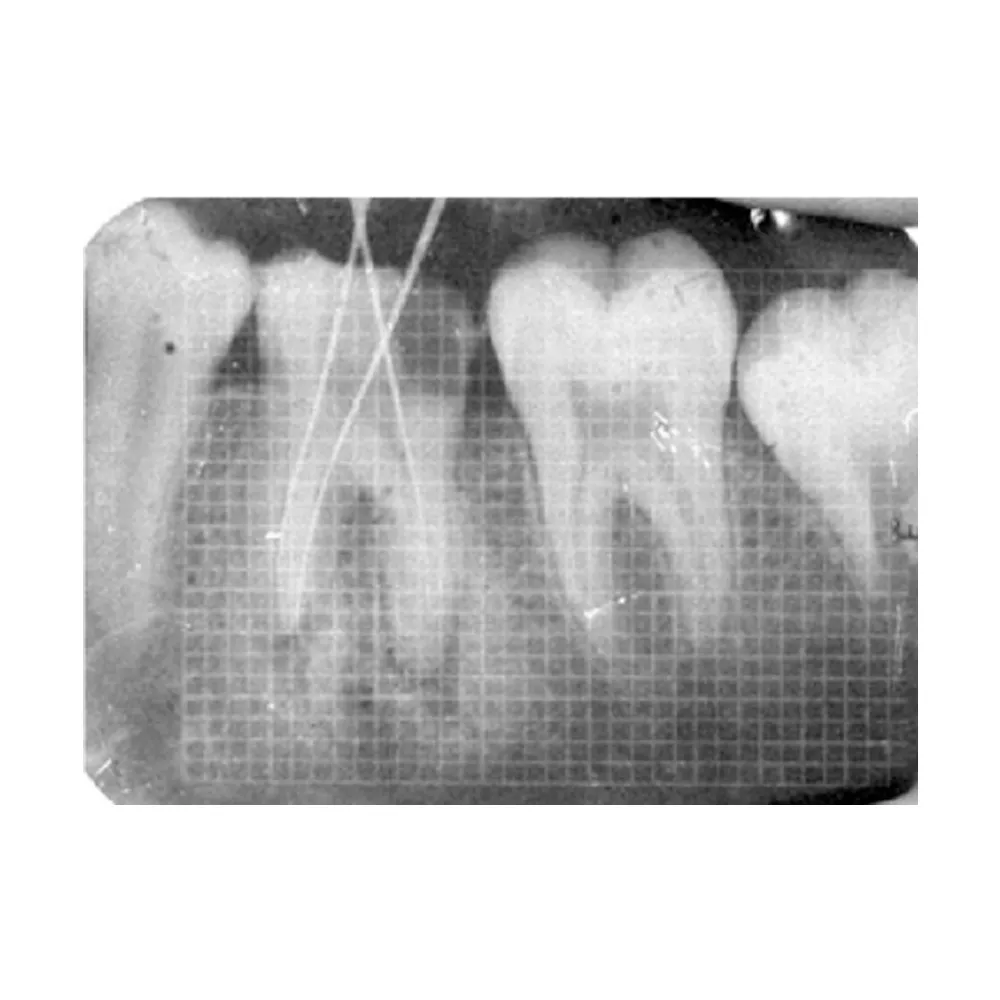 Dental IOPA X-Ray Grid