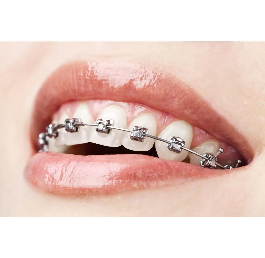 Buy ET Dental MBT 022 Mini Brackets Kit (Non-Extraction) At Best Price ...