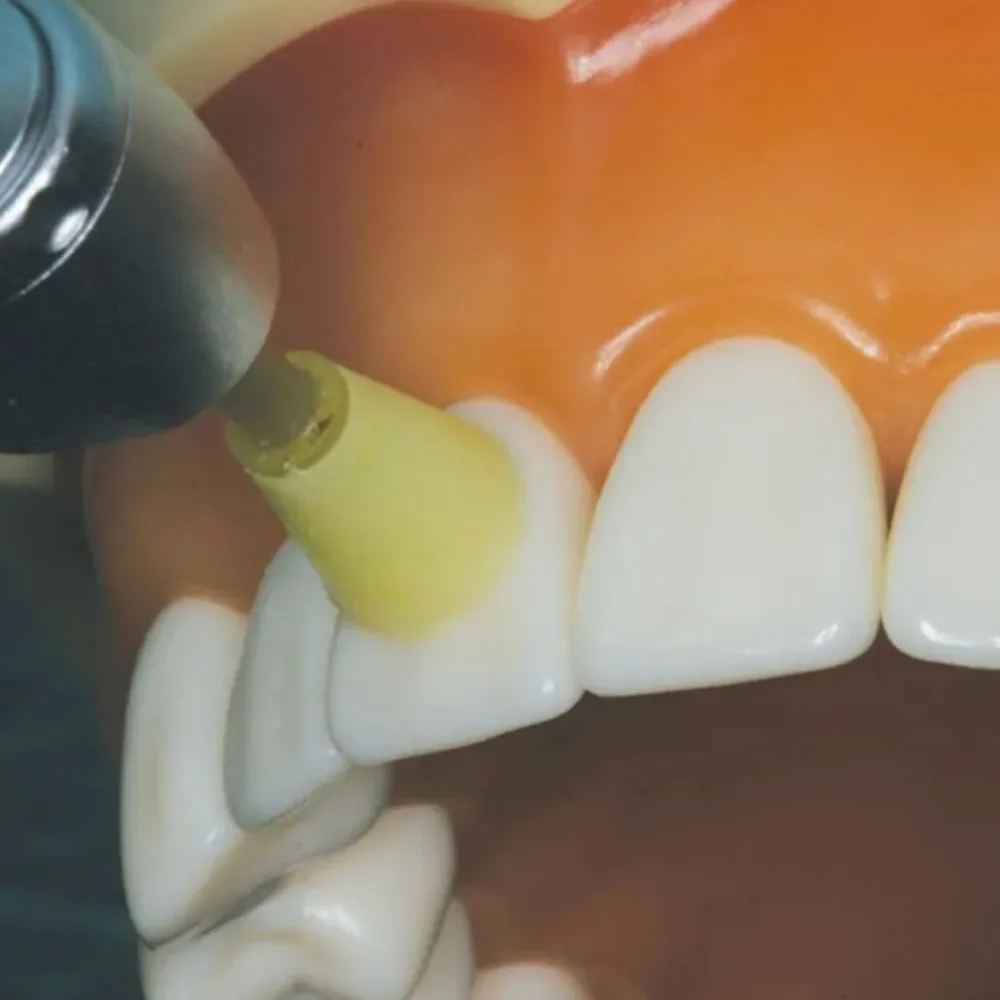 Younique IVeneer Injectable Matrix System