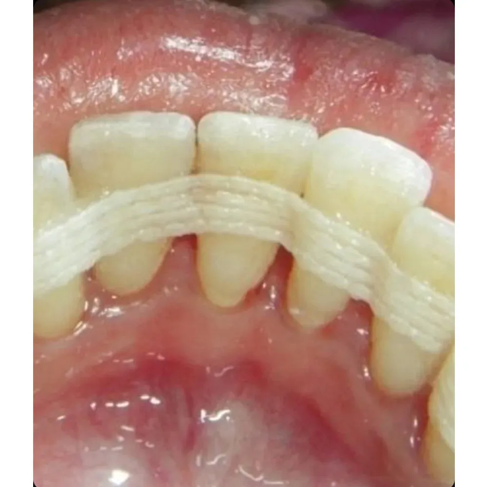 DentAct Fiber Splint 14cm