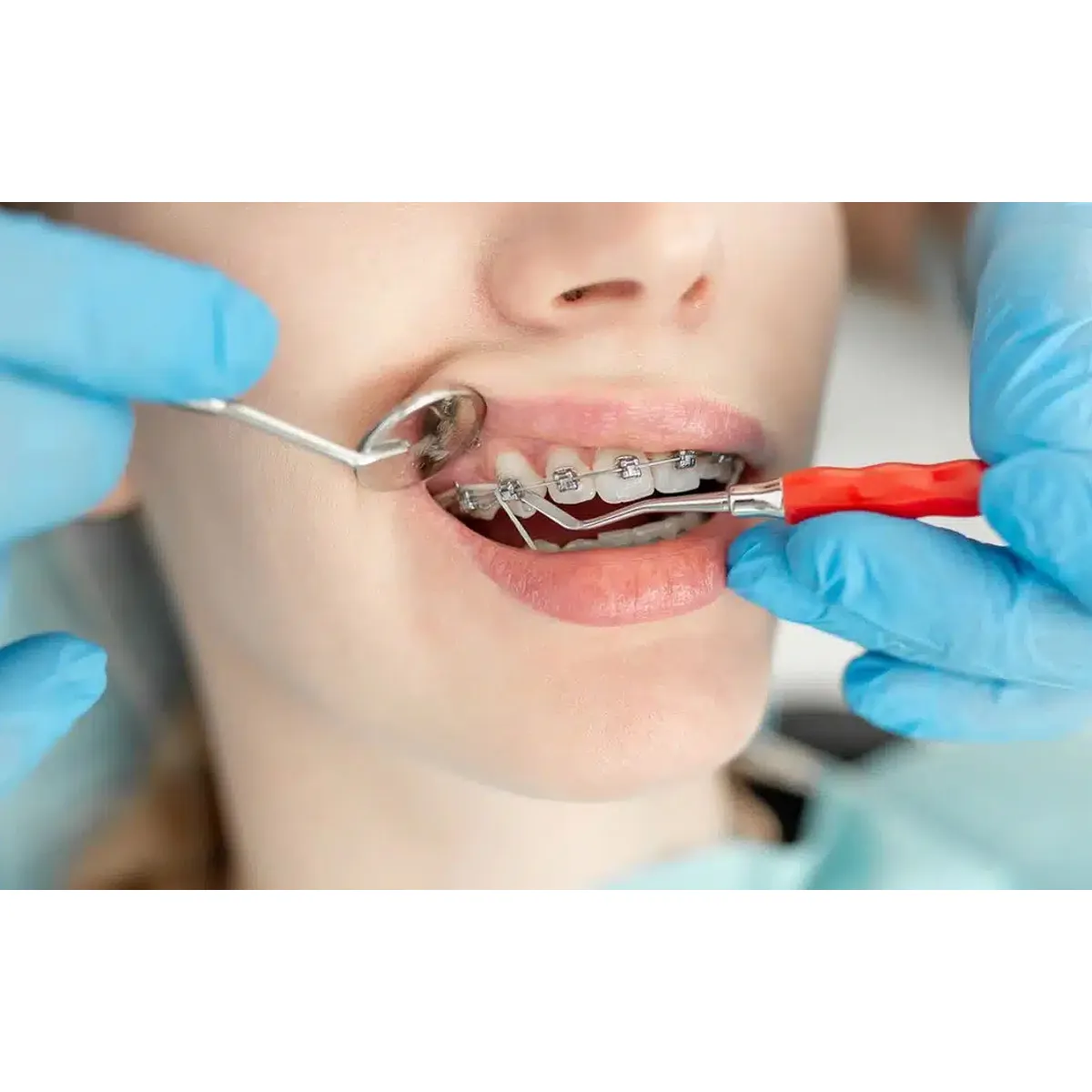 TP Ortho Plain Lime Extraoral Elastics 1/4" 8 Oz 1000/pk - 360-033 ...