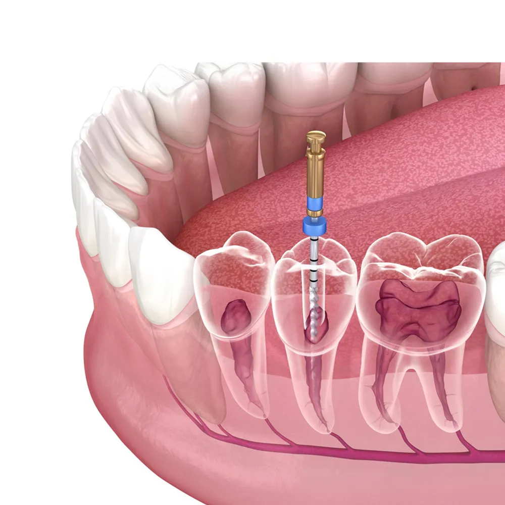 Medi Study Go Endodontics Mind Maps And Notes